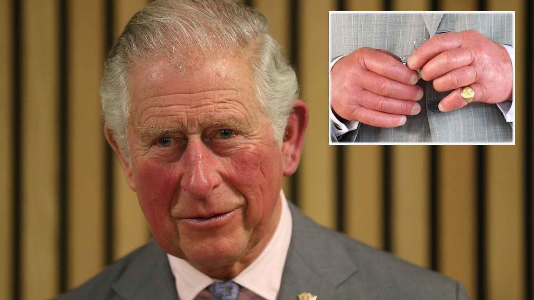 La enfermedad de Carlos III que le provoca una gran hinchazón en los ...